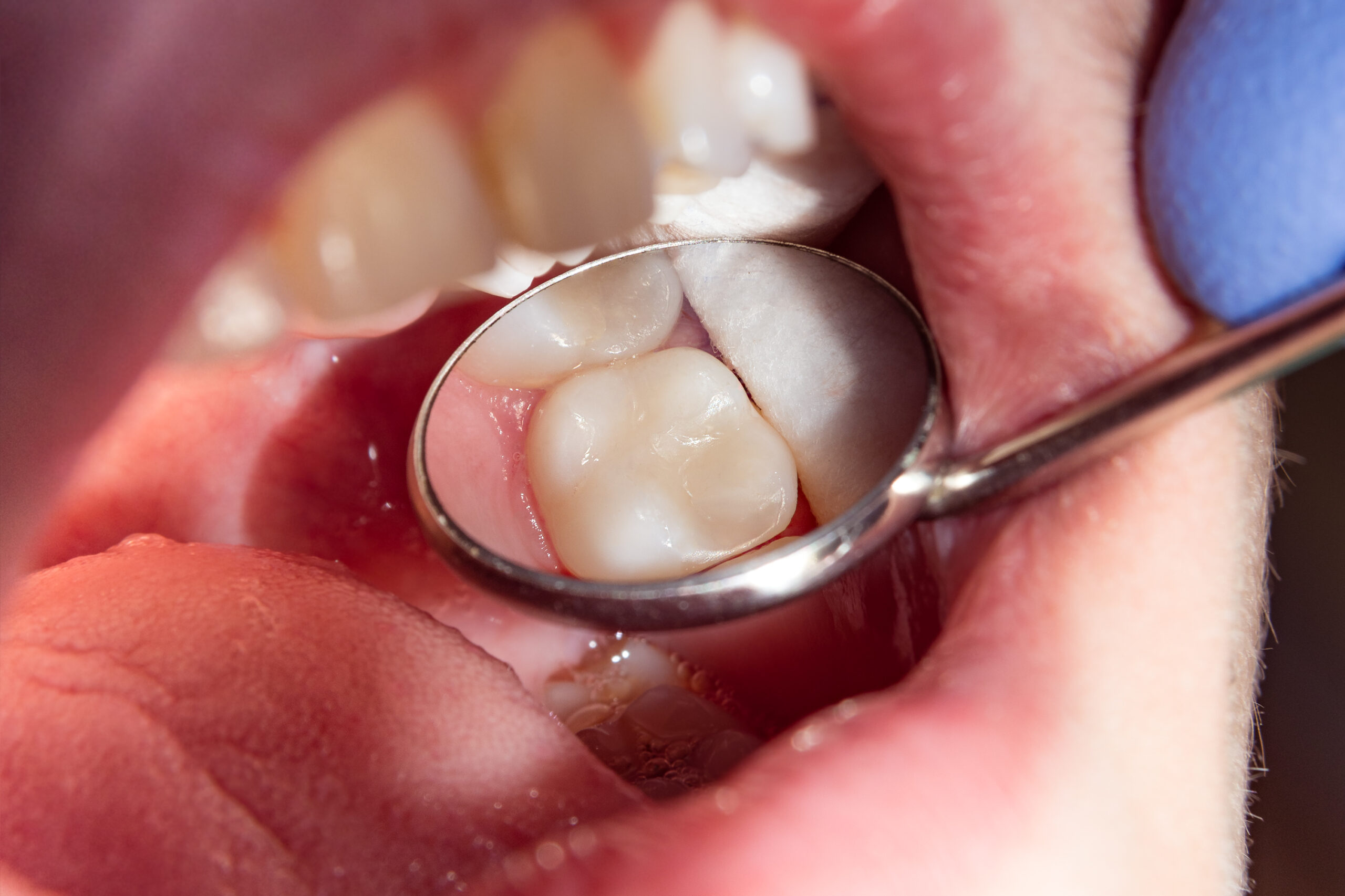 Your Guide to Composite Resin Fillings - Aspendale Gardens Dental Care