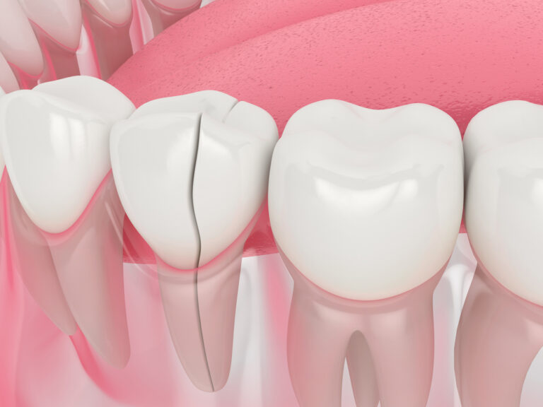 Tooth Broken but Root Still in Gums: Causes & Treatment
