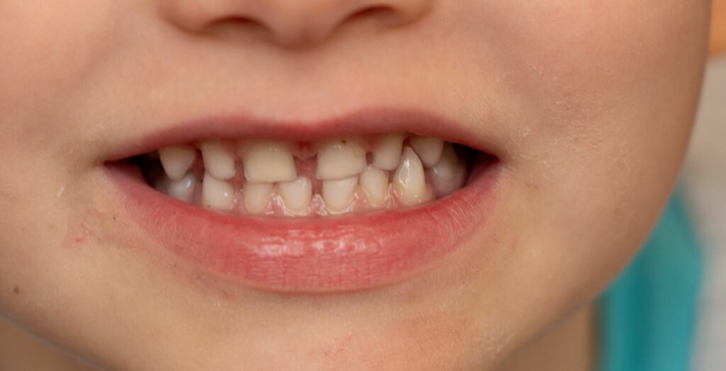 Baby Teeth Grinding: Causes & Treatment for Infant Bruxism